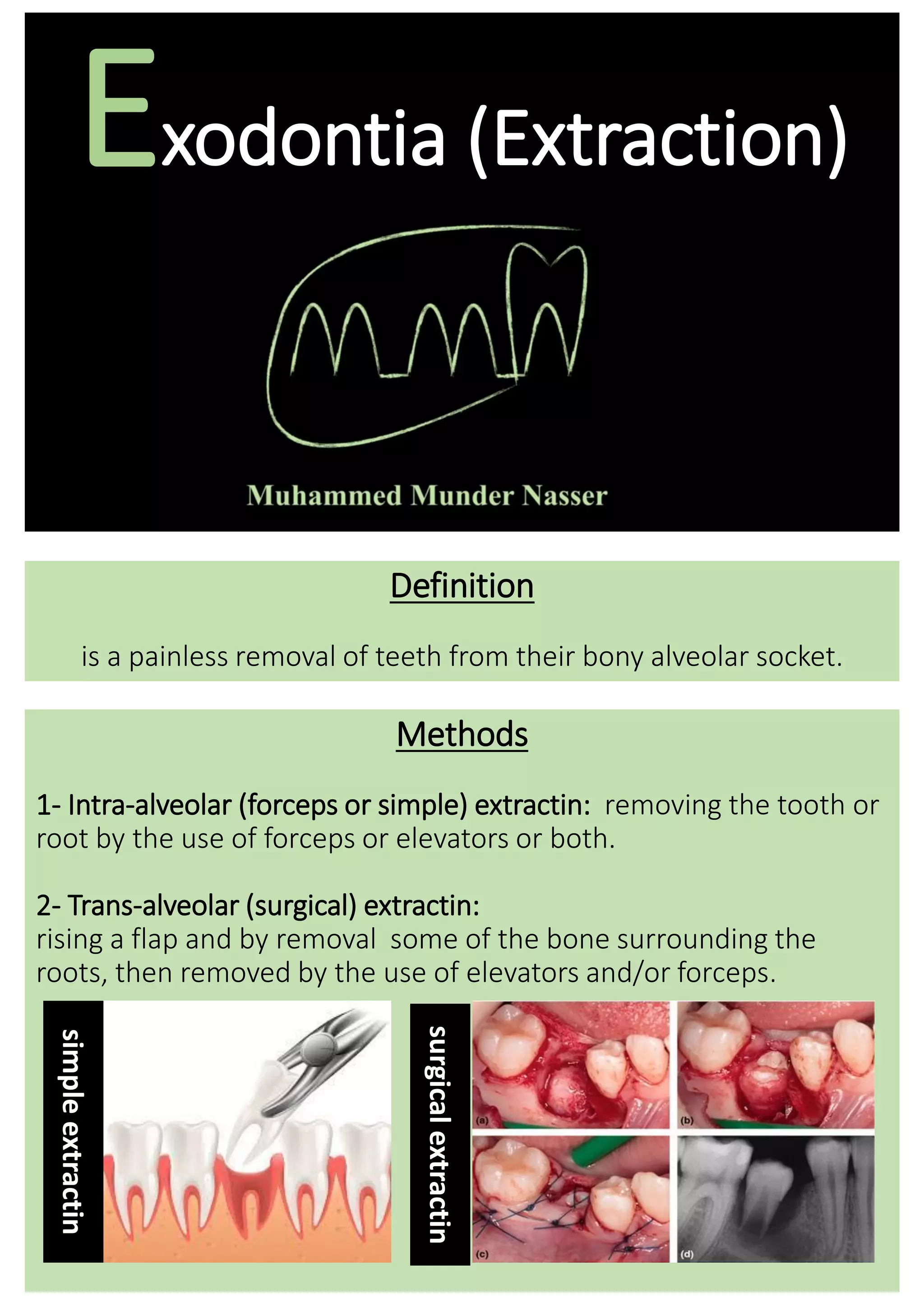 Exodontia (Extraction) | PDF
