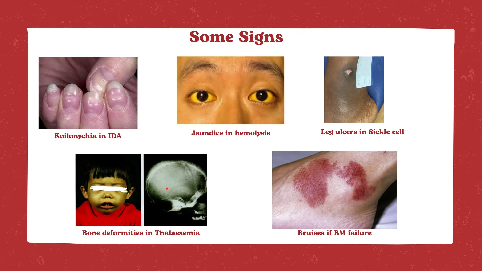 Approach to anemia , classification, investigations cases | PDF