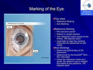 Cataract and Refractive Surgery.ppt