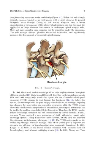 Vshape Bichannel Spinal Endoscopy Technique And Practice Shisheng He | PDF