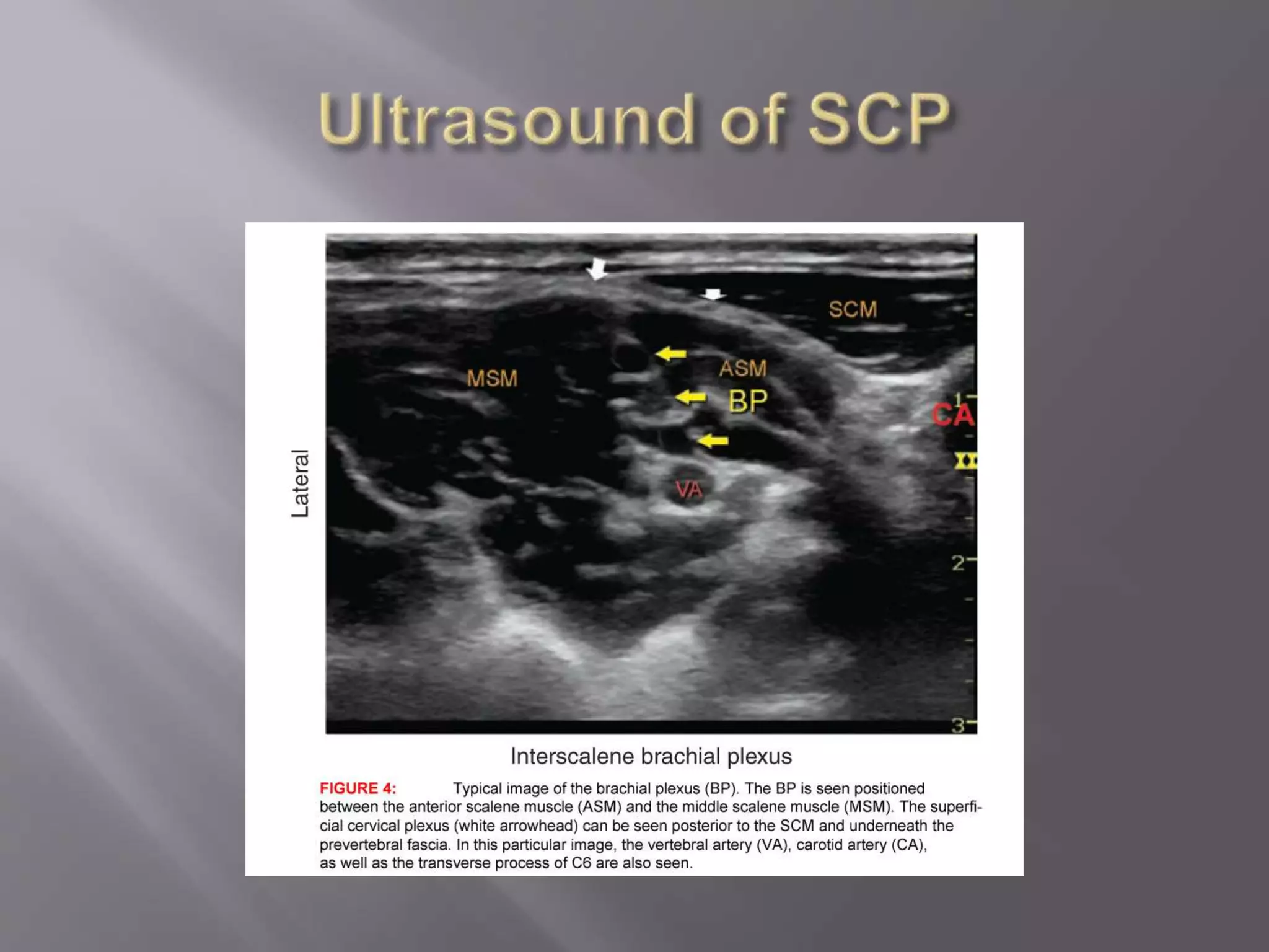 25820 - Cervical Plexus Block (1).pptx