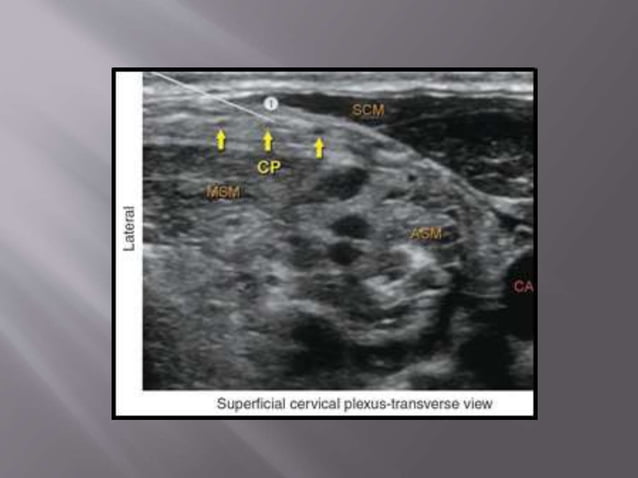 25820 - Cervical Plexus Block (1).pptx