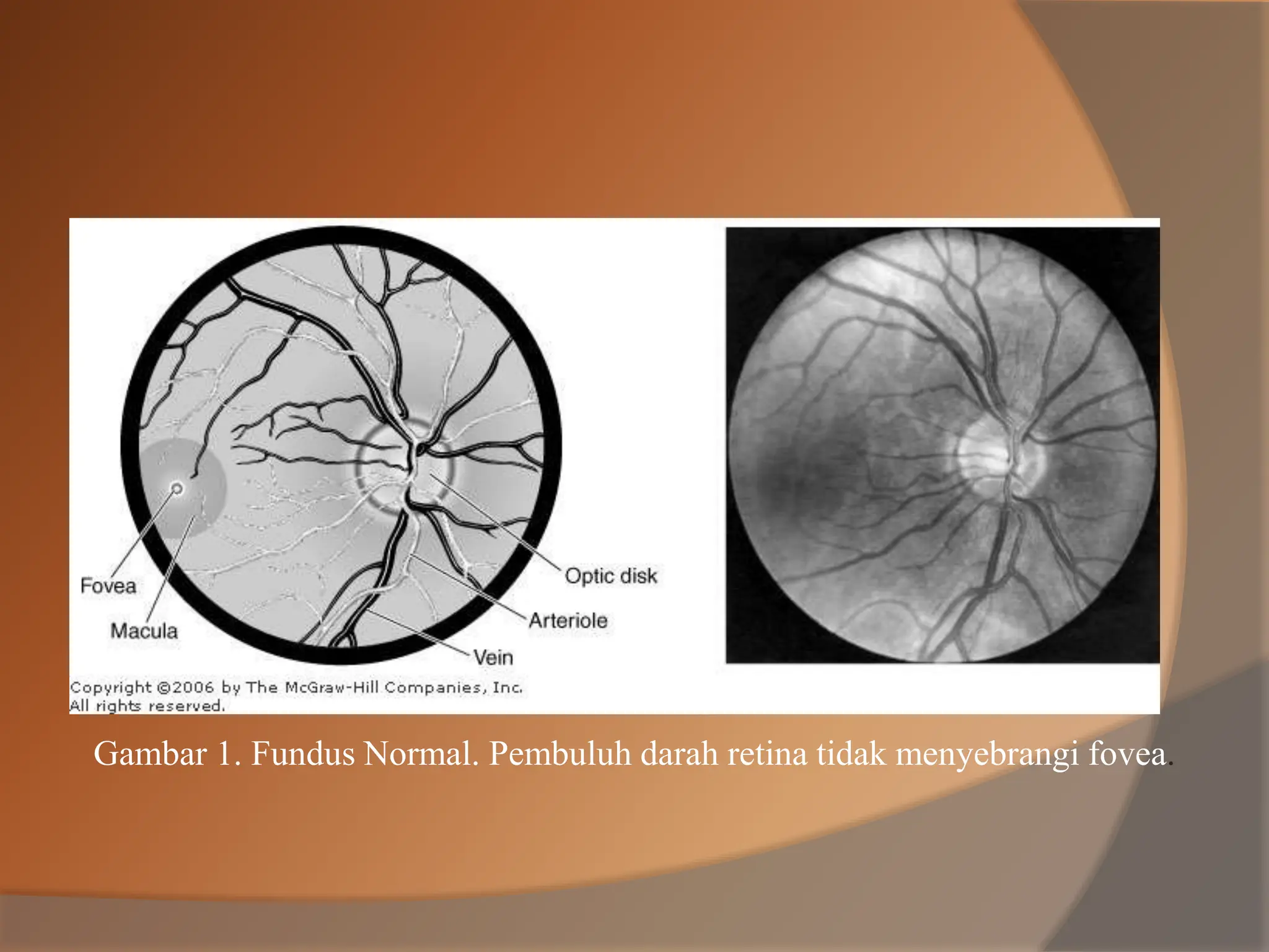 258776650-fundoskopi-pemfis-suherman.pptx