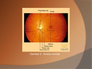 258776650-fundoskopi-pemfis-suherman.pptx