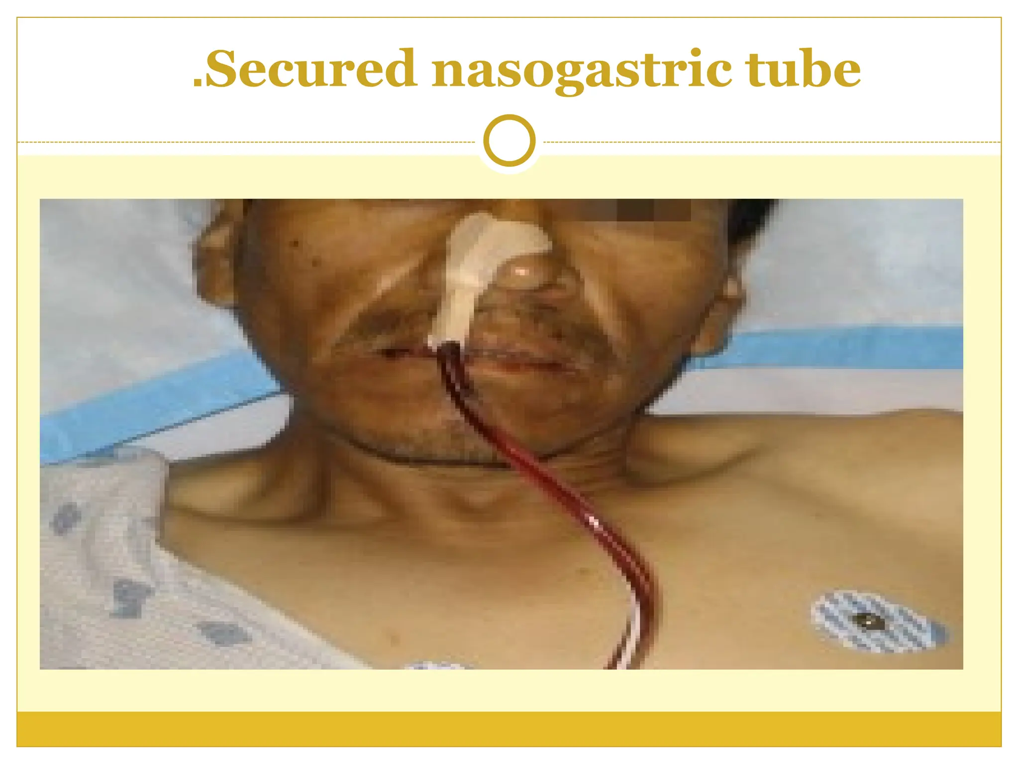 259153869-Procedure-of-Inserting-nasogastric-tube-ppt.ppt