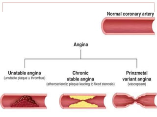 angina | PPT