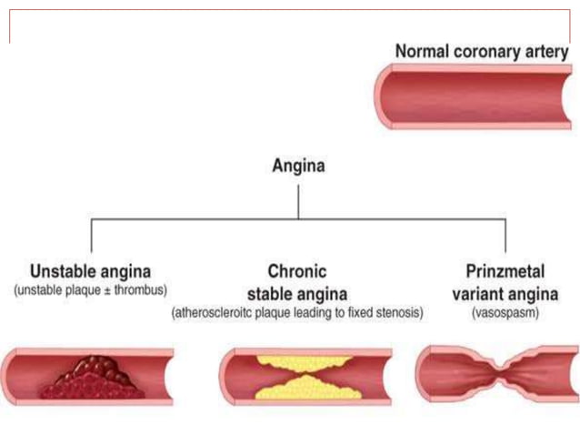 angina | PPT