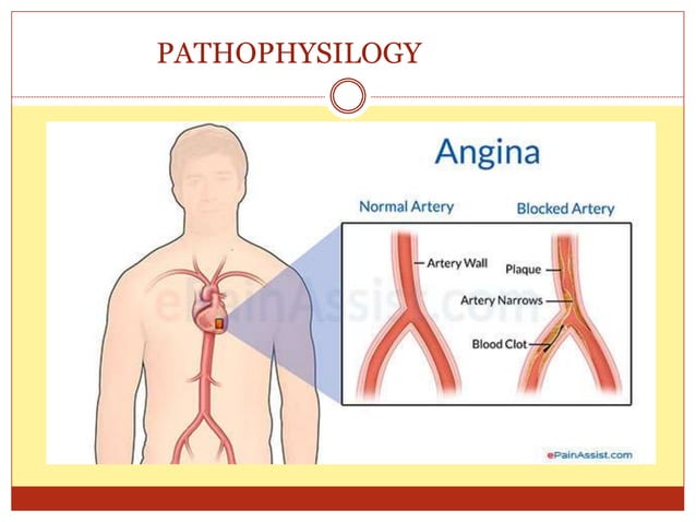 angina | PPT