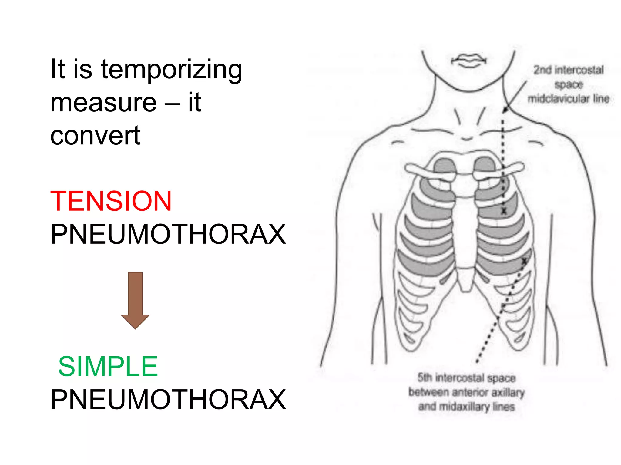 Tension pneumothorax | PPTX