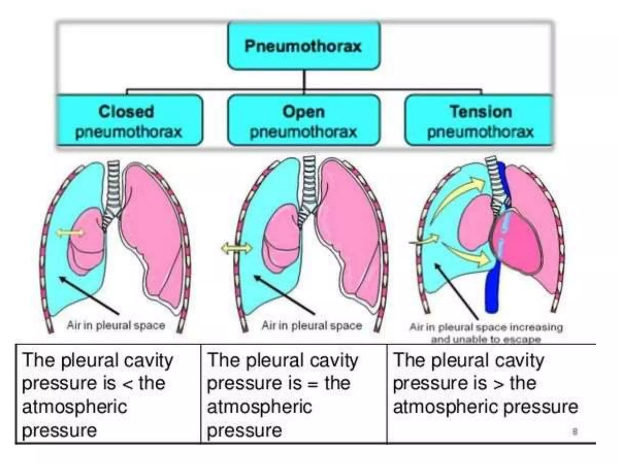 Tension pneumothorax | PPTX