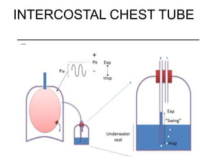 Tension pneumothorax | PPTX