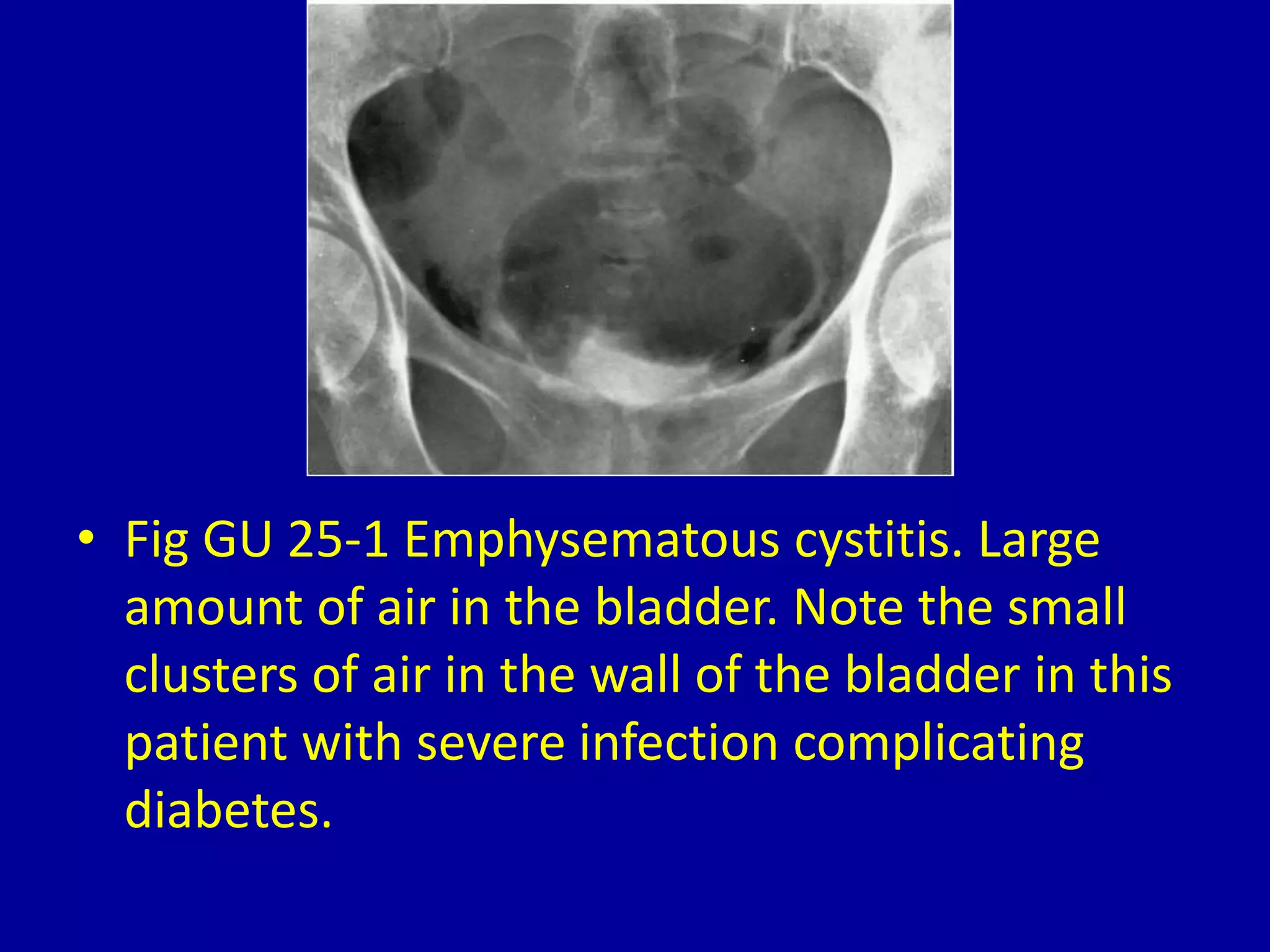 25 gas in the bladder lumen or wall | PPTX | Medical Health