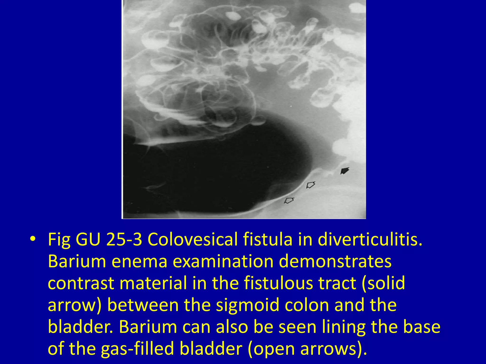 25 gas in the bladder lumen or wall | PPTX | Medical Health