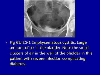 25 gas in the bladder lumen or wall | PPTX