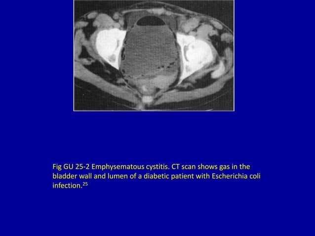25 gas in the bladder lumen or wall | PPTX | Medical Health