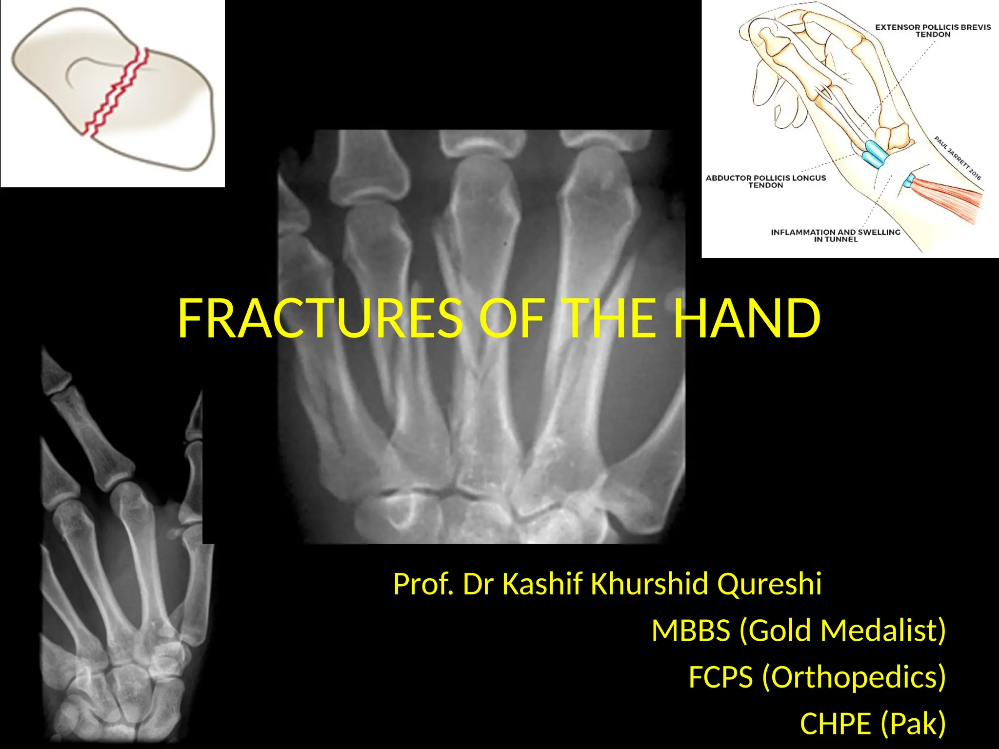 25 HAND FRACTURES & OTHER CONDITIONS.pptx