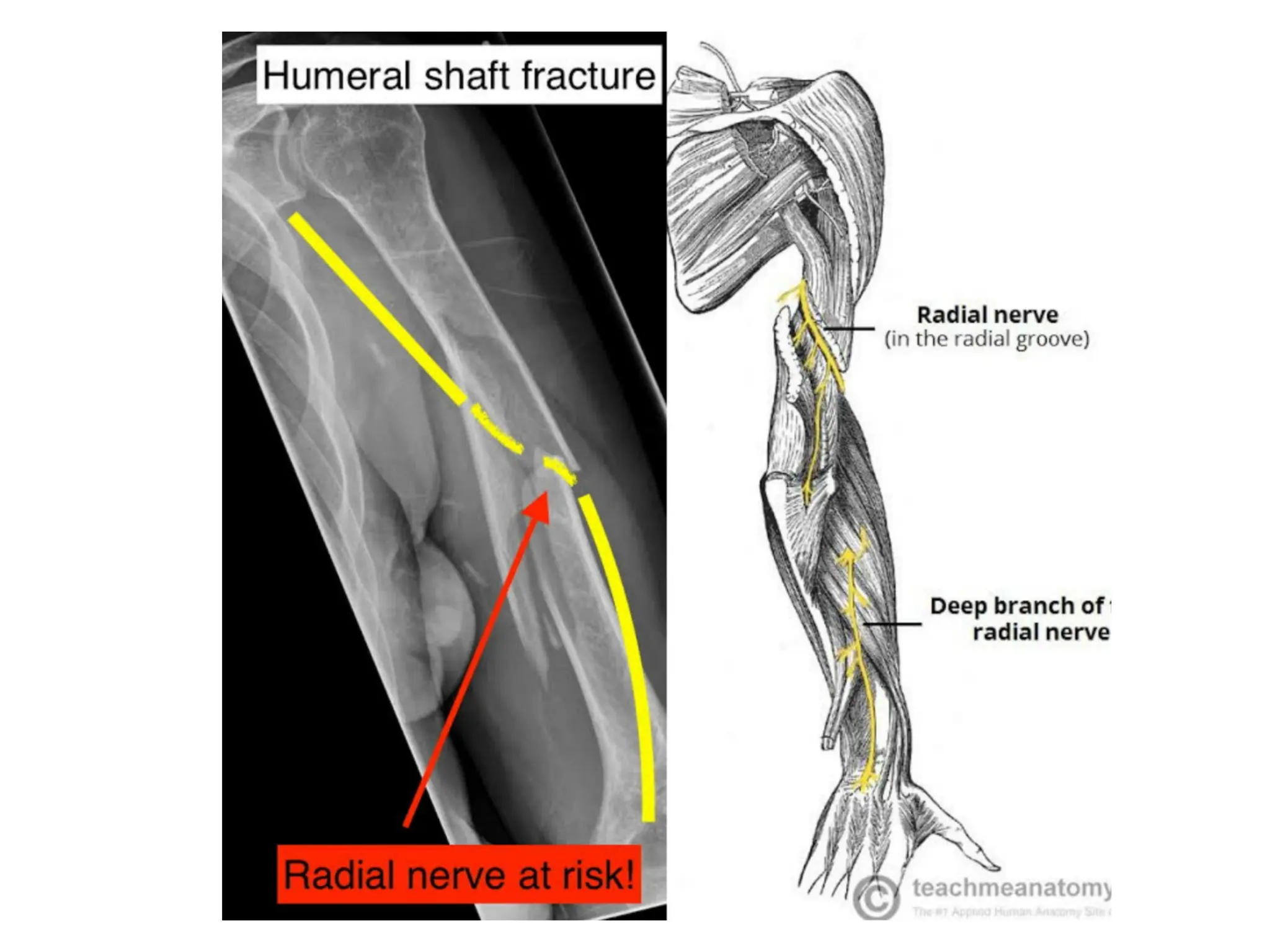 25 humerus shaft fx.pptx free download from here | PPT