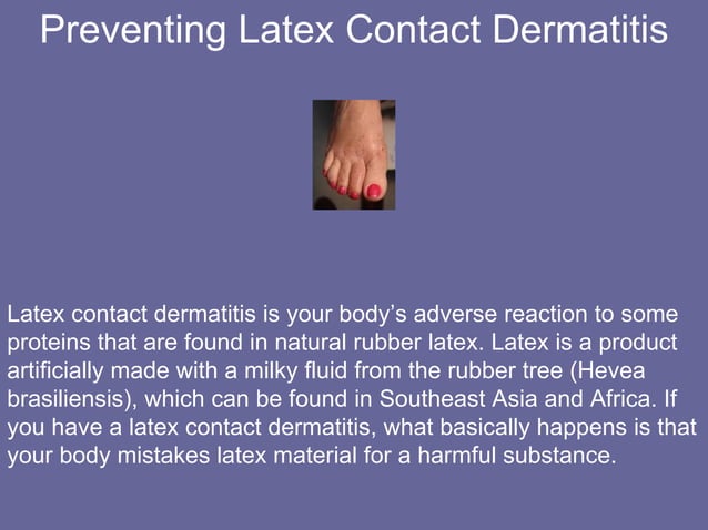 Preventing Latex Contact Dermatitis | PPT