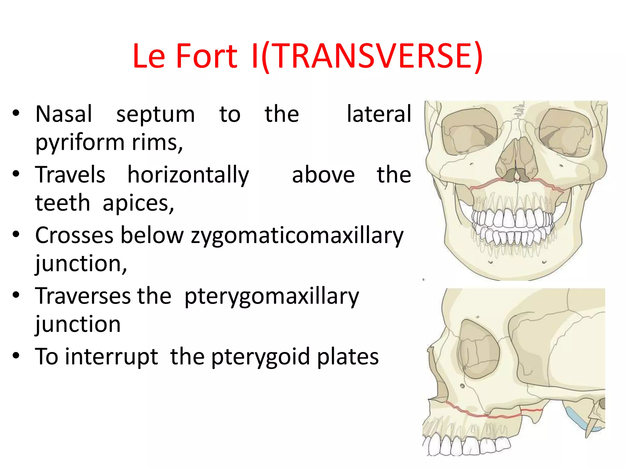 maxillofacial trauma | PPTX