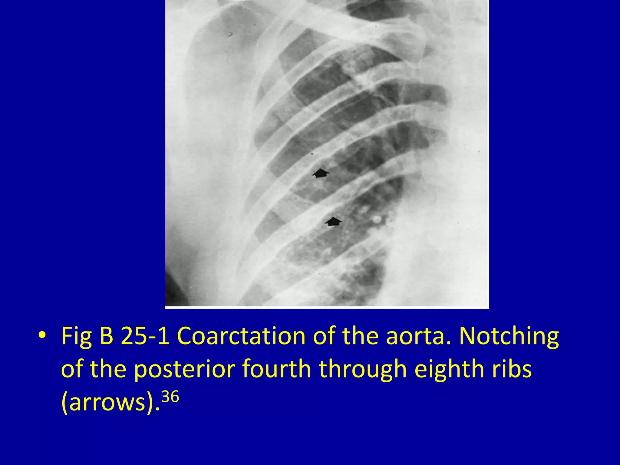 25 rib notching | PPTX