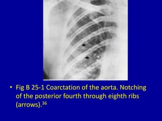 25 rib notching | PPT