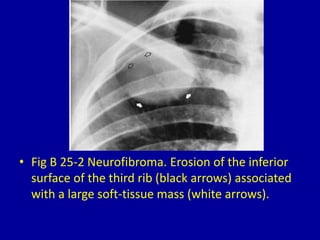25 rib notching | PPTX