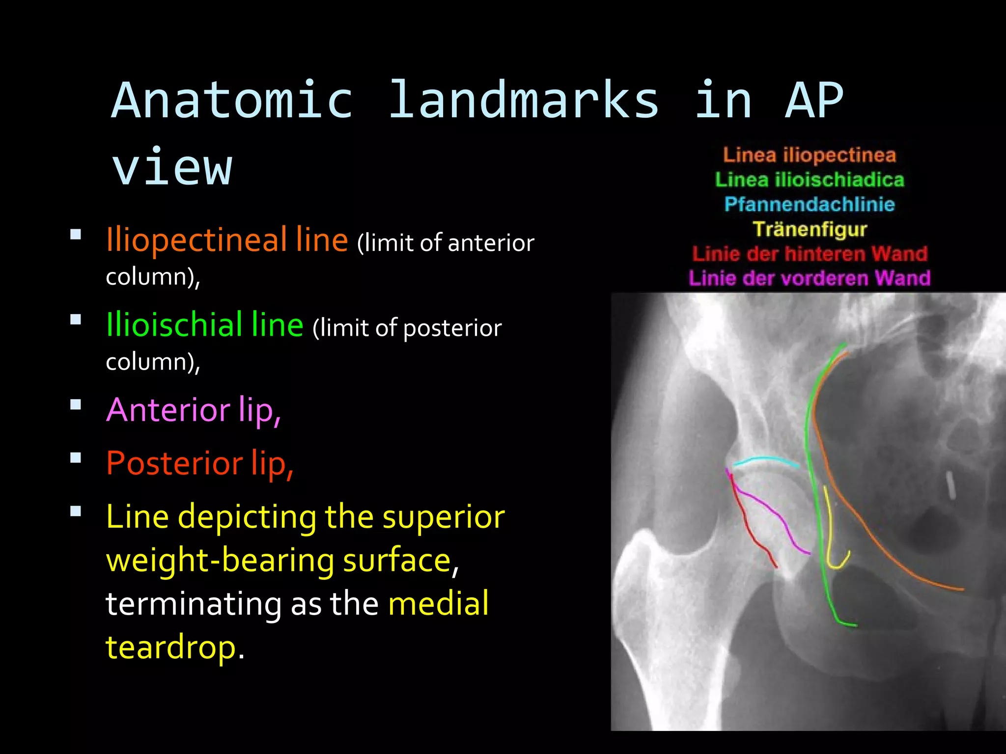 26. acetabular fractures anatomy, evaluation and classification ...