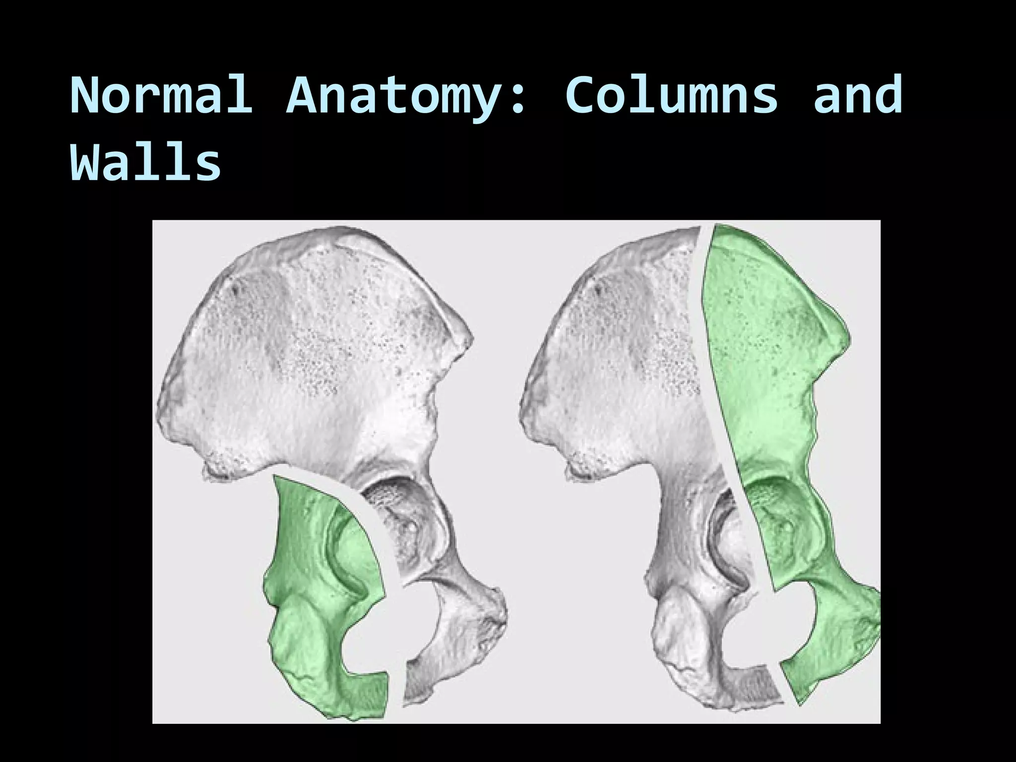 26. acetabular fractures anatomy, evaluation and classification ...