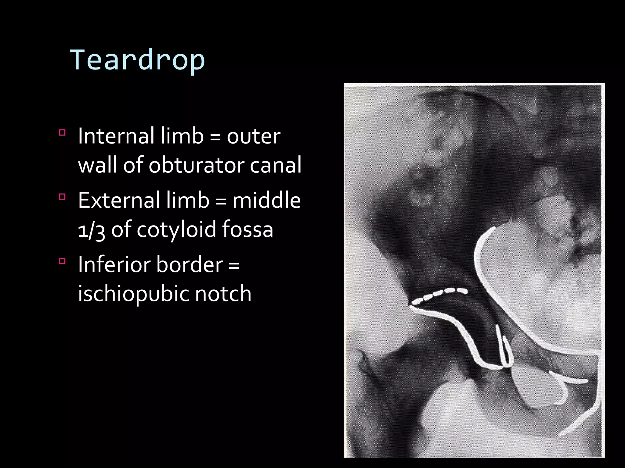 26. acetabular fractures anatomy, evaluation and classification ...