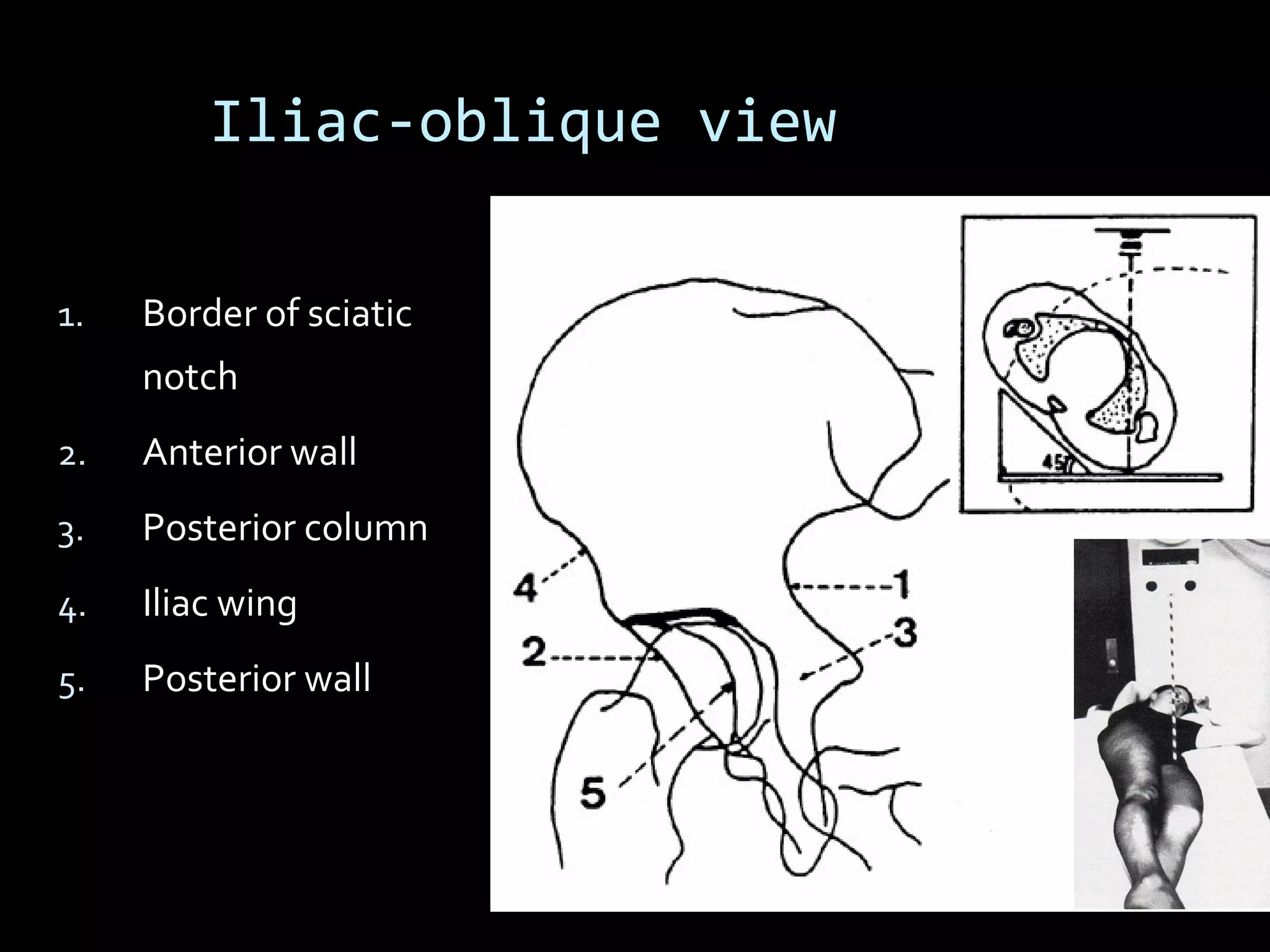 26. acetabular fractures anatomy, evaluation and classification ...