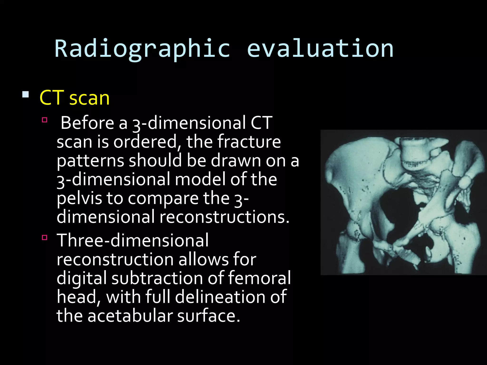 26. acetabular fractures anatomy, evaluation and classification ...