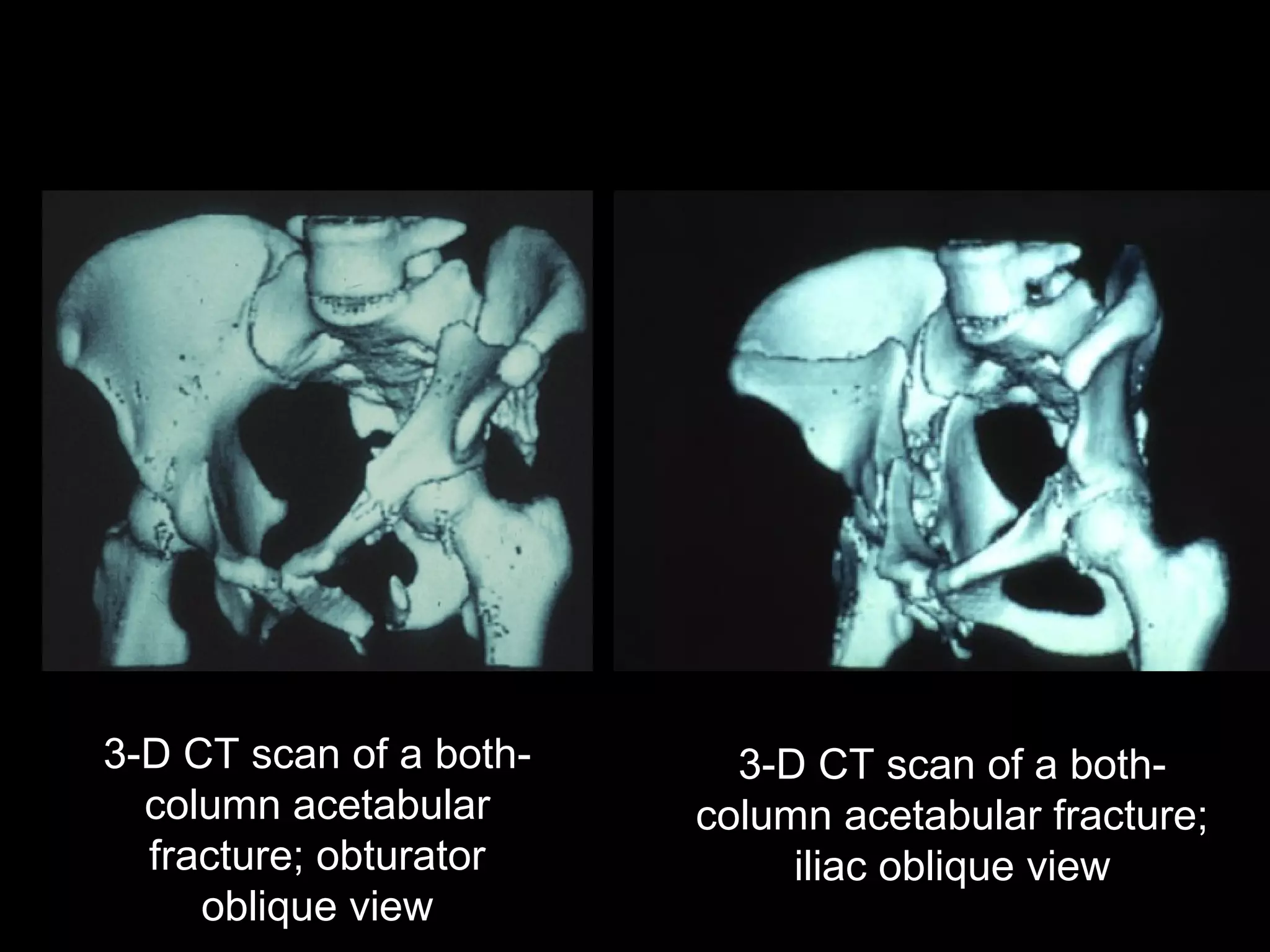 26. acetabular fractures anatomy, evaluation and classification ...