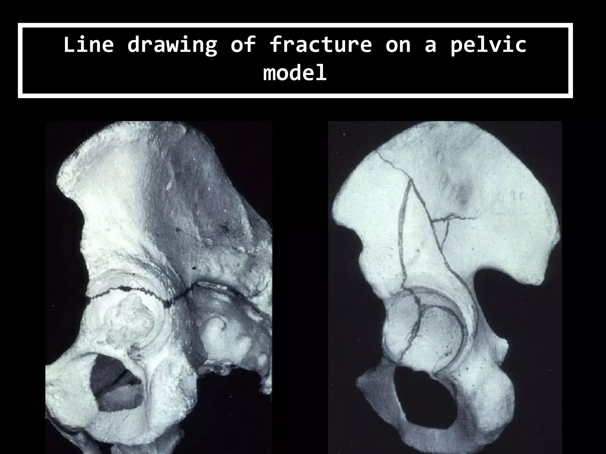 26. acetabular fractures anatomy, evaluation and classification ...