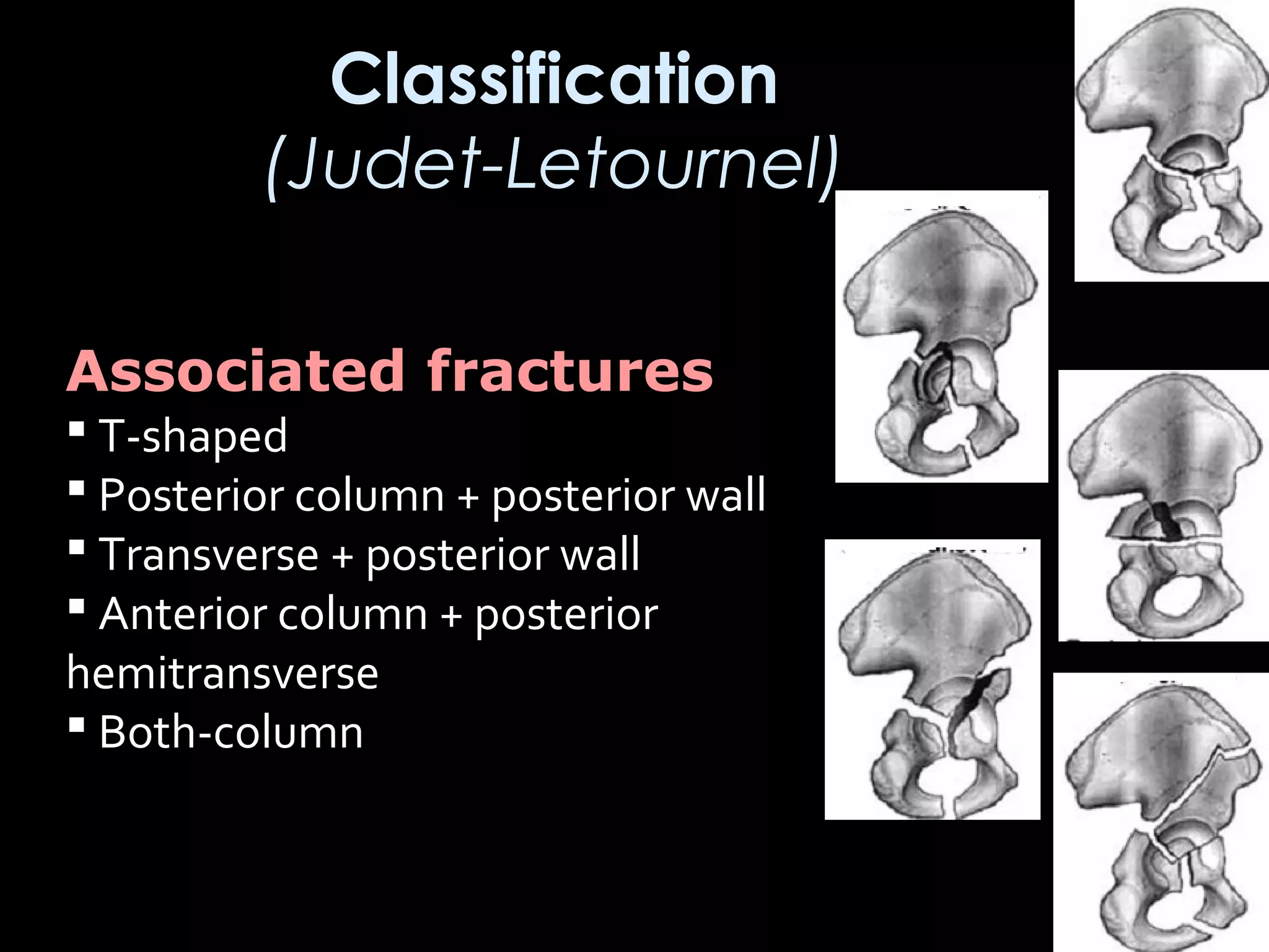 26. acetabular fractures anatomy, evaluation and classification ...