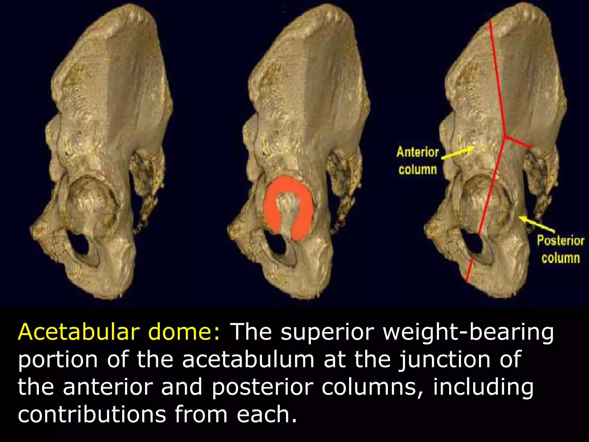 26. acetabular fractures anatomy, evaluation and classification ...