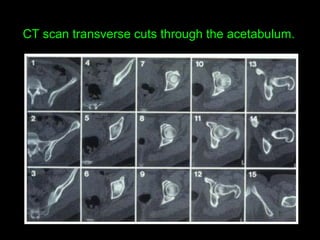 26. acetabular fractures anatomy, evaluation and classification ...