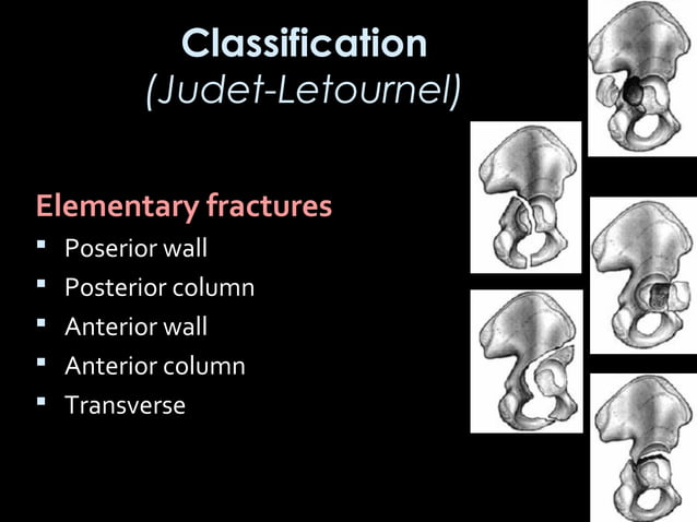 26. acetabular fractures anatomy, evaluation and classification ...