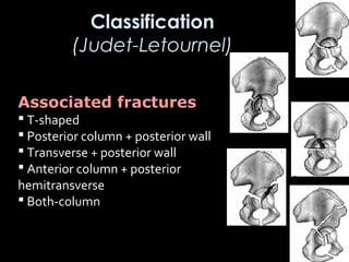 26. acetabular fractures anatomy, evaluation and classification ...