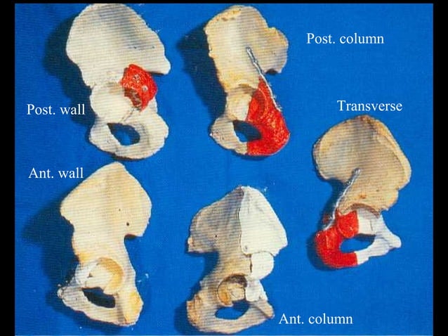 26. acetabular fractures anatomy, evaluation and classification ...