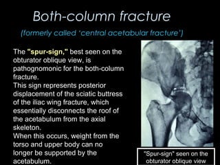 26. acetabular fractures anatomy, evaluation and classification ...