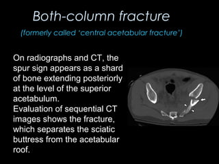 26. acetabular fractures anatomy, evaluation and classification ...