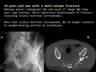 26. acetabular fractures anatomy, evaluation and classification ...