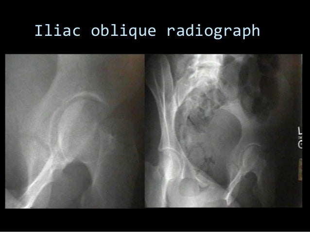 26. acetabular fractures anatomy, evaluation and classification