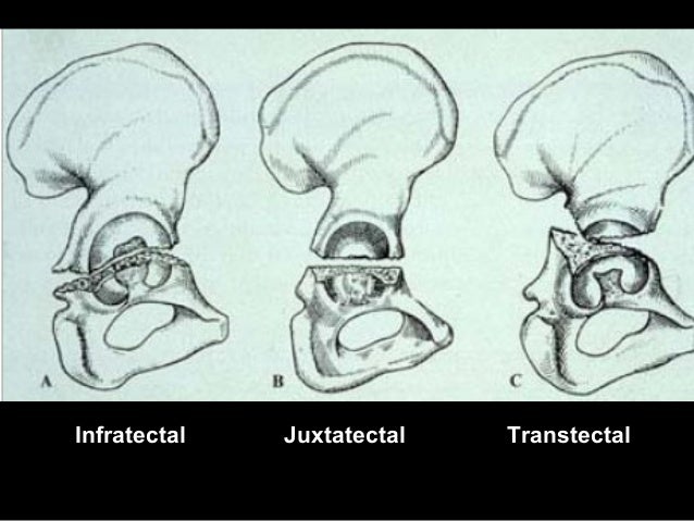 26. acetabular fractures anatomy, evaluation and classification