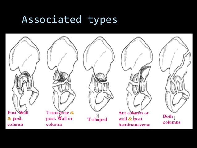 26. acetabular fractures anatomy, evaluation and classification