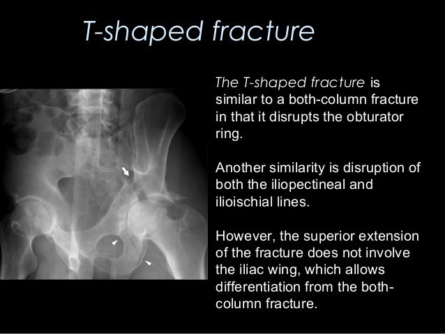 26. acetabular fractures anatomy, evaluation and classification