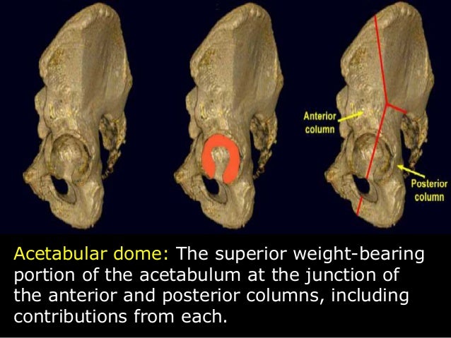 26. acetabular fractures anatomy, evaluation and classification