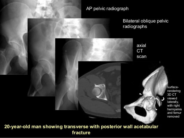 26. acetabular fractures anatomy, evaluation and classification