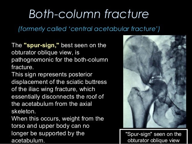 26. acetabular fractures anatomy, evaluation and classification