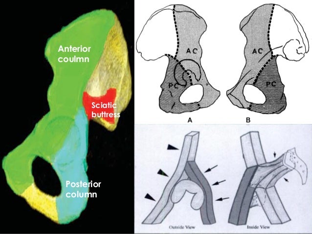 Acetabular Fractures Presentation and Treatment | Bone and Spine
